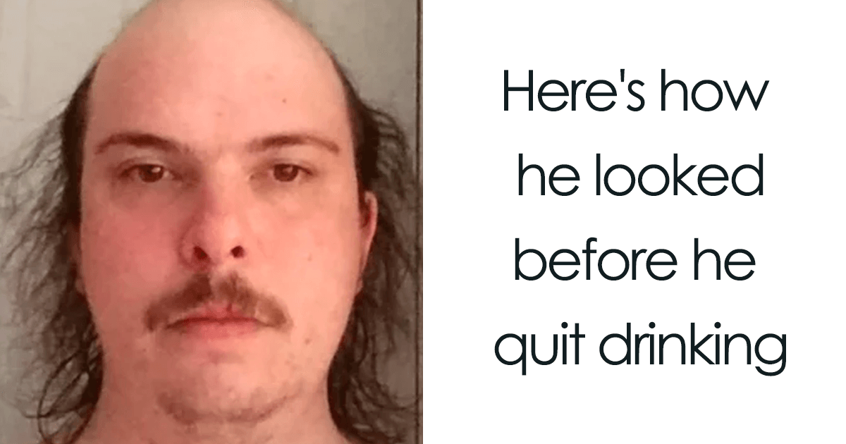 20+ Before & After Pics That Show What Happens When You Stop Drinking ... 20+ Before & After Pics That Show What Happens When You Stop Drinking ...